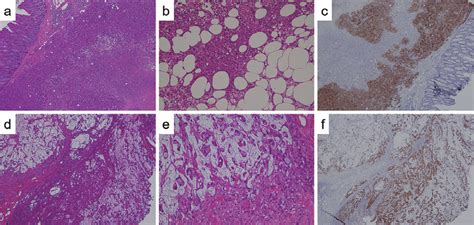 Figure1histopathological Findings Of The Two Cases Of Colorectal Download Scientific Diagram