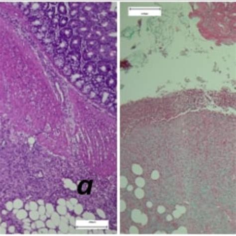 Significant Neovascularization And Mild Re Epithelialization Score 3