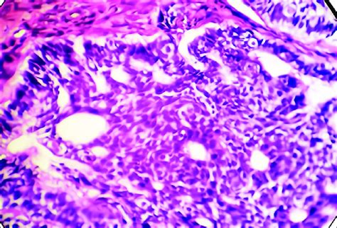 40 × View Of Basaloid Cells With Few Cystic Spaces Download Scientific Diagram