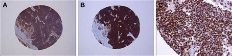 Tissue Microarray Immunohistochemistry Notes A Neuron Specific