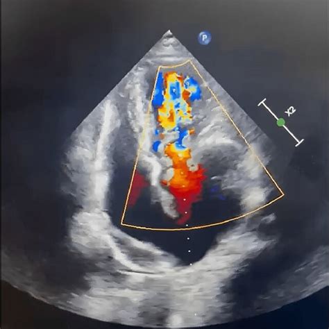 Echocardiography Showing Mitral Stenosis And Mitral Regurgitation