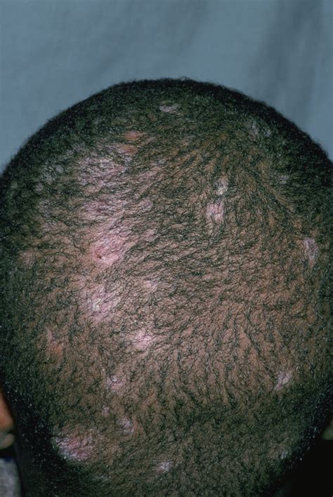 Pimplelike Bumps On The Scalp