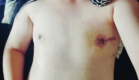 2 Weeks And Few Days Post Op 🤘 Scrolller