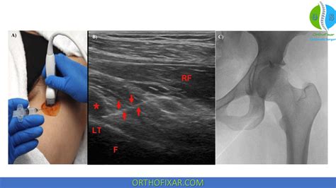 Iliopsoas Bursa Injection Easily Step By Step Orthofixar