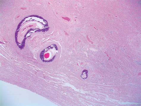 Monckeberg S Arteriosclerosis A Case Report Of Chronic Endo Menopause