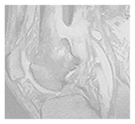 Comparison On Mri Images Processed By Wavelet Algorithm A Original