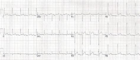 Topic Acute Pericarditis 12 Lead Ecg Certification Course Acls
