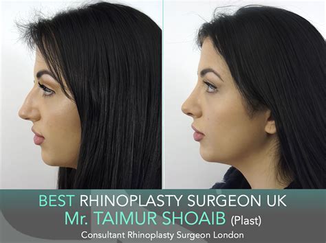 Best Rhinoplasty Surgeon London Uk Female Before After 105 Berkeley