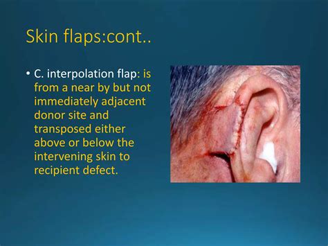 Flaps In Surgery Pptx