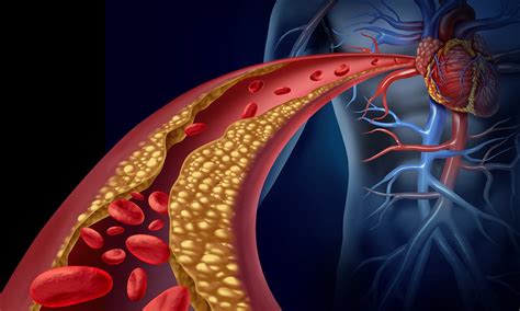 Hypercholesterolemia E Clinic And Diagnostics