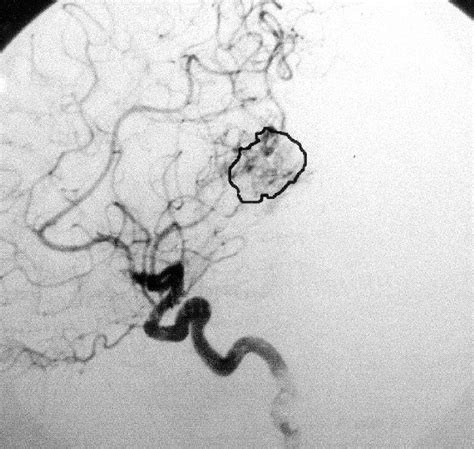 Angiography Of The Left Ica Lateral View After Embolization Download Scientific Diagram
