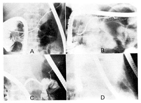 The Normal Endoscopic Pancreatogram In Koreans Pmc