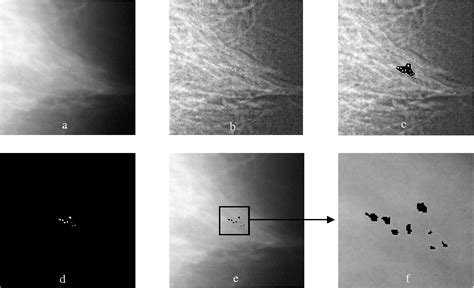 figure 1 from using texture of tissue surrounding microcalcifications