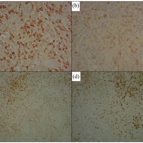 Polyclonal Kappa Positive A And Lambda Positive B Plasma Cell Download Scientific Diagram