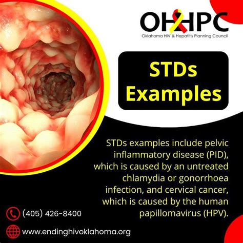 Sexually Transmitted Infections Stis Causes And Prevention Artofit