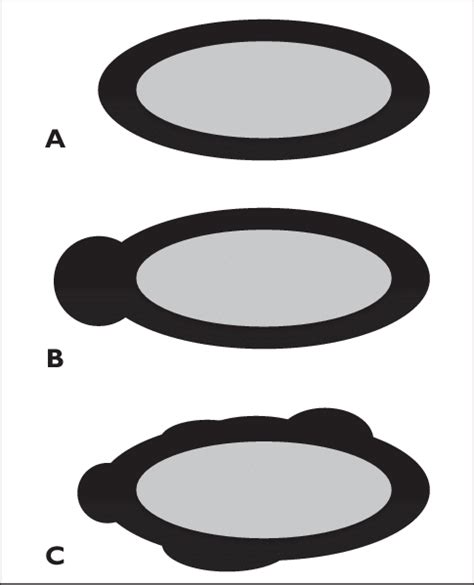 Drawings Schematically Show Normal Lymph Node A C Lymph Node With Download Scientific Diagram