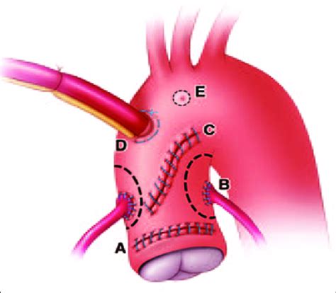 Schematic Diagram Shows Common Locations For Postoperative Aortic Root