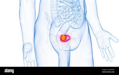Bladder Cancer Illustration Stock Photo Alamy
