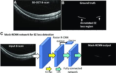 Scan By Scan Ellipsoid Zone Ez Loss Detection And Segmentation Using Download Scientific