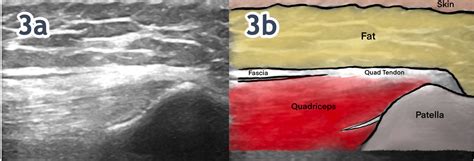 Quadriceps Muscle Strain Physiopedia Patellar Fractures Physiopedia