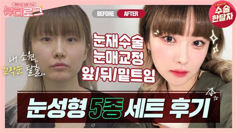 눈성형 5종 세트로 꼬막눈 탈출★ 금비의 눈재수술 Vlog 성형후기 트임부터 비절개 눈매교정까지~ Youtube
