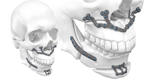 Kls Martin Ips® Implants