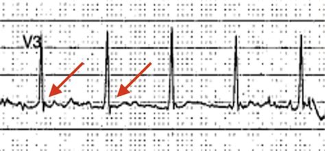 Rare Ecg Finding In A Patient With Severe Hypercalcaemia Bmj Case Reports
