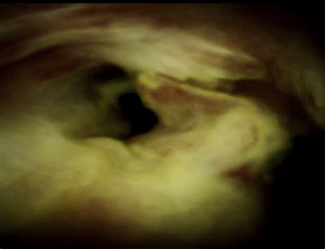 Digital Cholangioscopy For Targeted Photodynamic Therapy Of