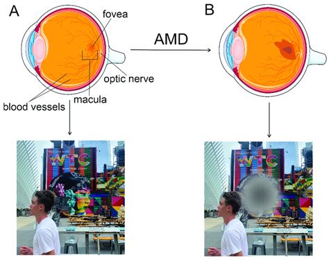 Advanced Age Related Macular Degeneration Amd Leads To Disturbances Download Scientific