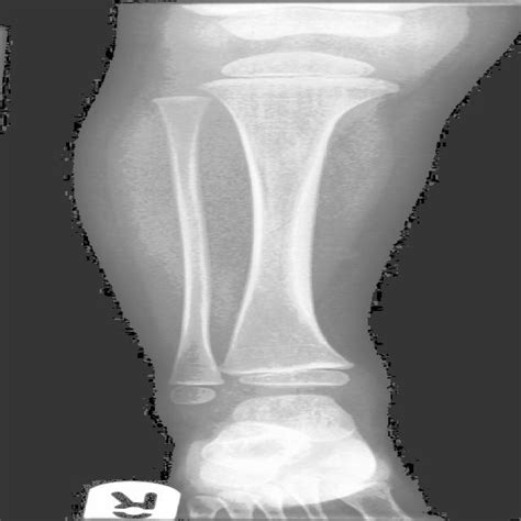 Bone Classification Model By Bone Bone Classification Model By Bone