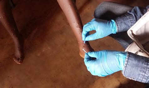 Zimbabwe Reports First Cases Of Mpox Who Regional Office For Africa