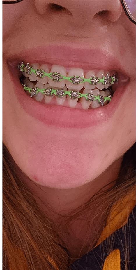 Progress 8 Months Posted Earlier About What Color To Get Next Lol R
