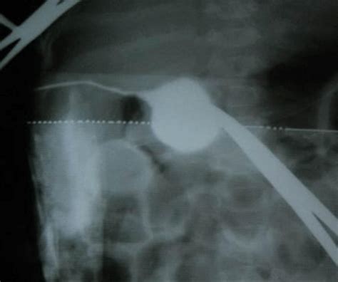 Peroperative Cholangiogram Showing Gall Bladder Draining Into Cdc With