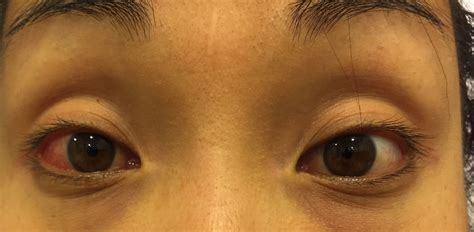 My Eye Eyes Before Taking Doxycycline July 8 2015