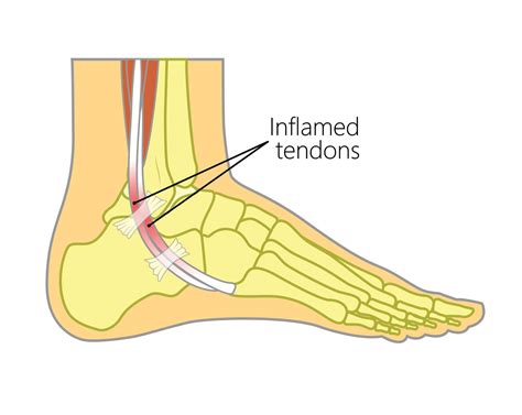 Tendons And Ligaments In Foot And Leg Muscles That Lift The Arches Of The Feet Qsaudrlz