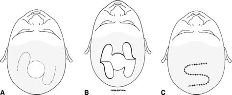 Dual Transposition Flaps For The Reconstruction Of Large Scalp Defects Journal Of The American