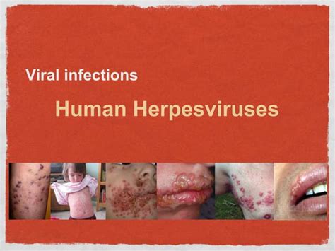 Herpes Simplex Virus Pptx Herpes Simplex Virus Pptx
