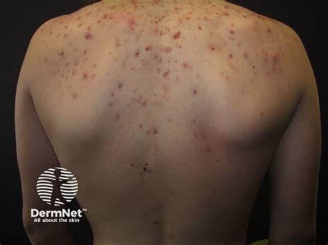 Acne Management