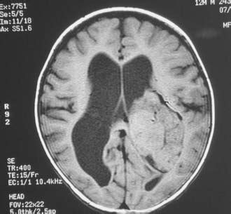 Choroid Plexus Tumors Neupsy Key