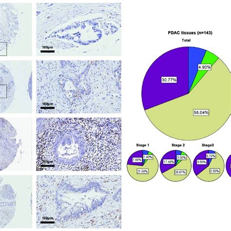 Cd4 T Cell Spatial Distribution Patterns In The Tumor Tissue