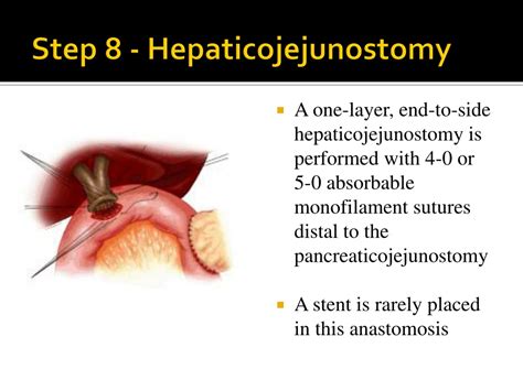 Ppt Carcinoma Pancreas Powerpoint Presentation Free Download Id 471994