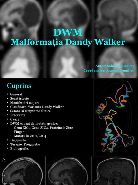 Dandy Walker Malformation Pdf