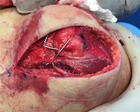 Olecranon Fracture Fixation Surgical Technique Published In Surgicoll