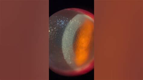 Pseudomembrane In Adenoviral Conjunctivitis аденовирусли конюнктивит