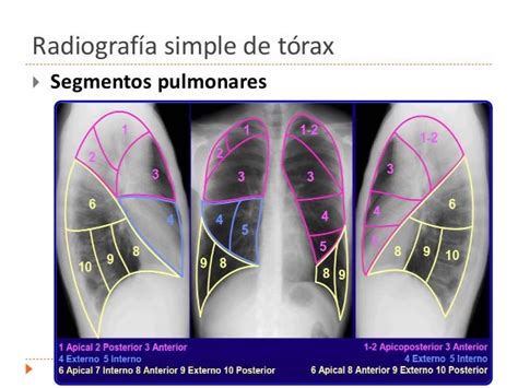 Radiografía Simple Y Tomografía De Tórax