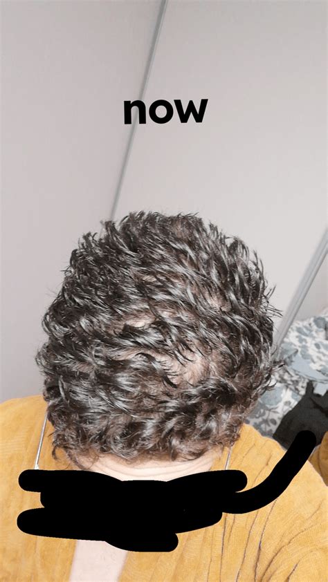 15 And Diffuse Thinning Rmalehairadvice