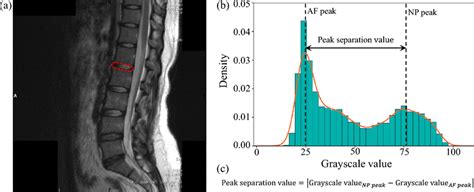 Diagram Of Peak Separation Value Measurement Through Mri Histogram