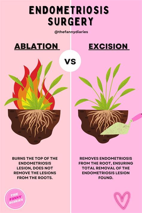 Surgery For Endometriosis Artofit