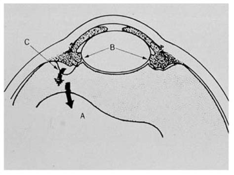 Secondary Angle Closure Glaucoma Part 2 Flashcards Quizlet