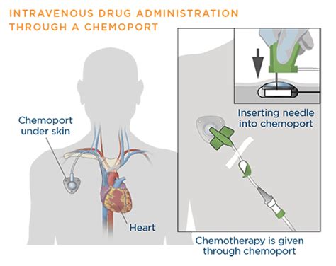 Chemotherapy For Lung Cancer Treatment